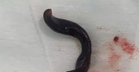 Con đỉa dài 4cm sống trong mũi người đàn ông